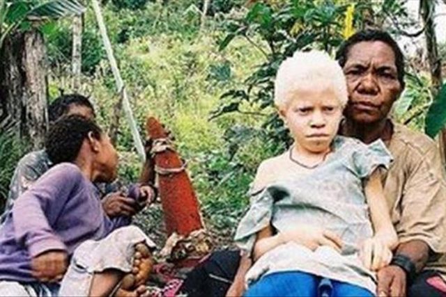 Albinism seen in 1 out of 17,000 people worldwide - Timeturk Haber